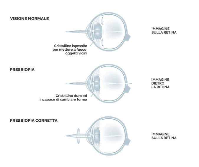 Cos'è la presbiopia semplice e come contrastarla | Twins Optical